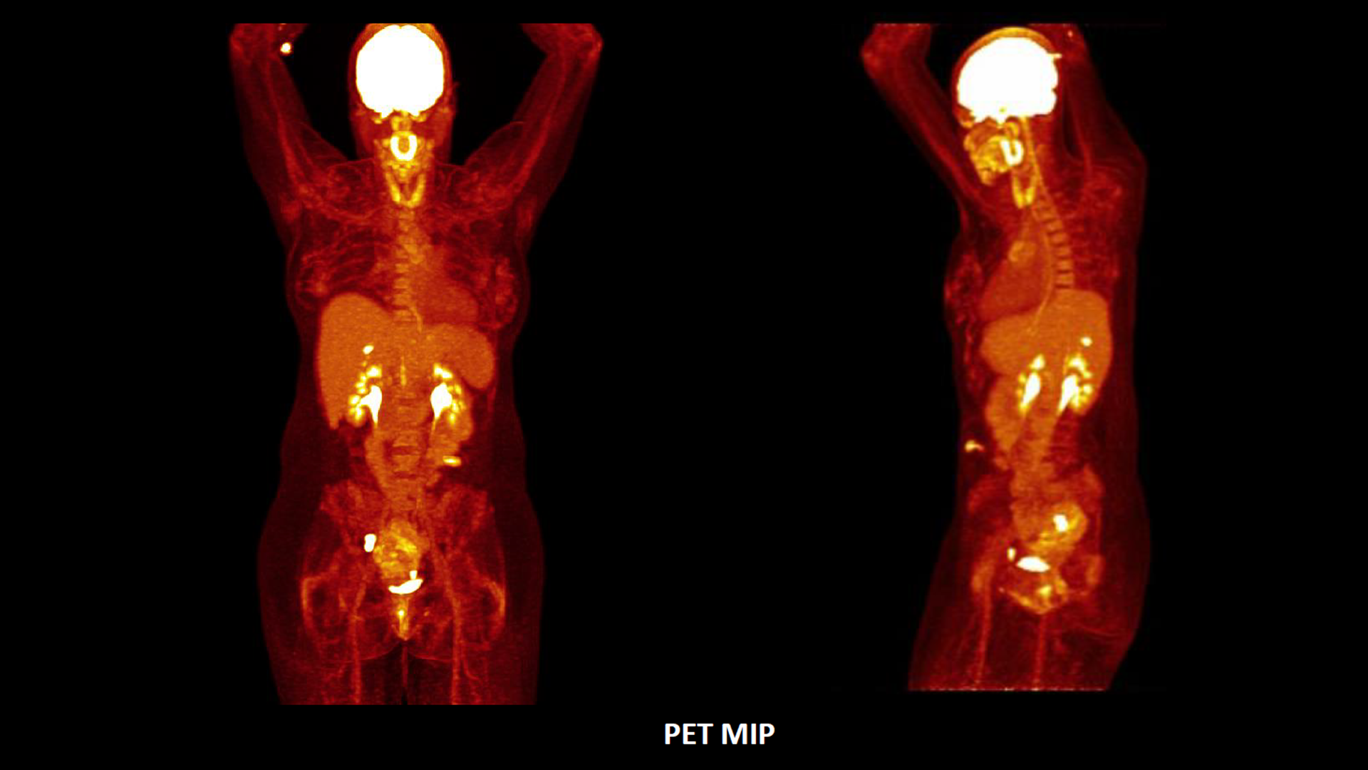 Biograph Vision PET/CT Scanner - Siemens Healthineers