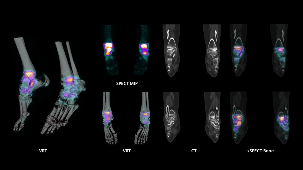 SPECT/CT in musculoskeletal medicine - Siemens Healthineers