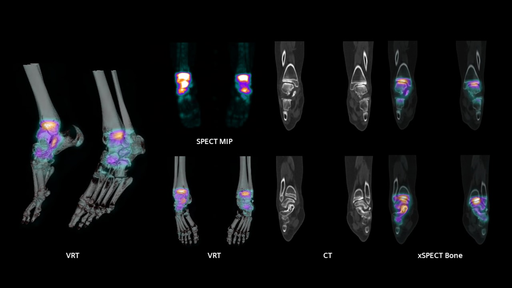 SPECT/CT in musculoskeletal medicine - Siemens Healthineers