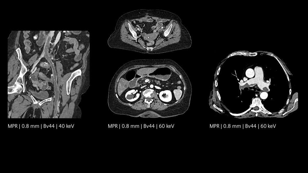 PCCT pulmonology imaging - Siemens Healthineers