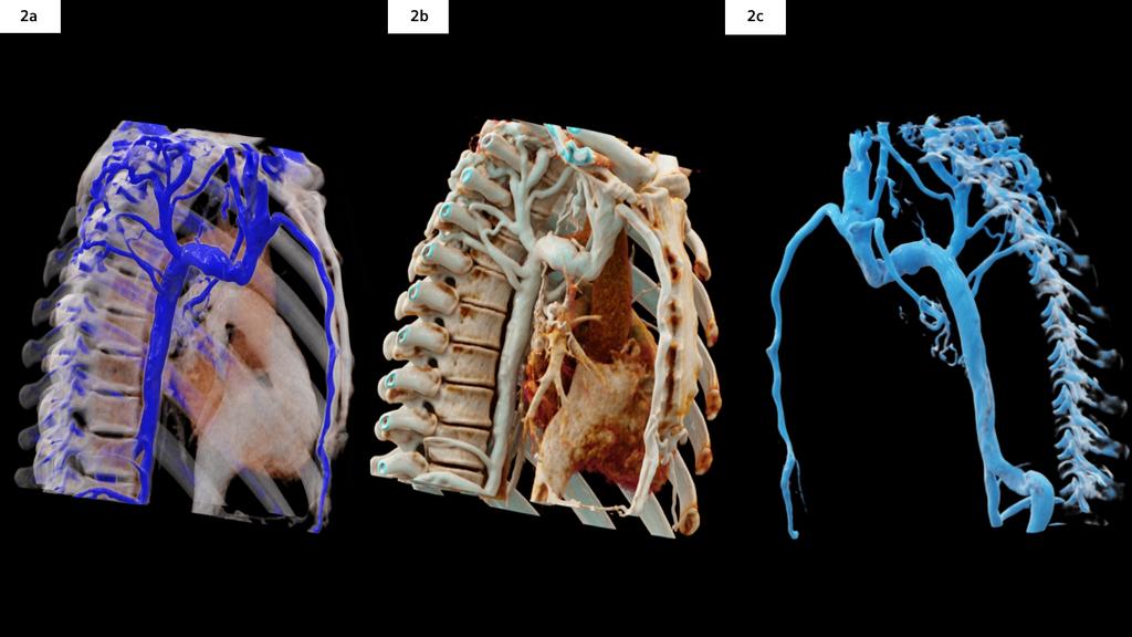 Superior vena cava obstruction caused by a primary mediastinal large B ...
