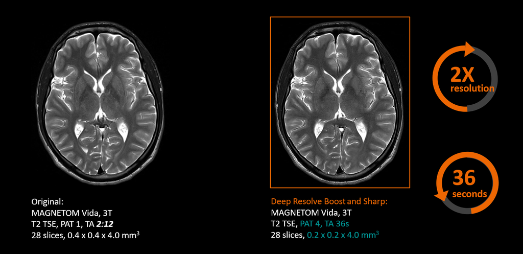 Deep Resolve Boost - Siemens Healthineers USA