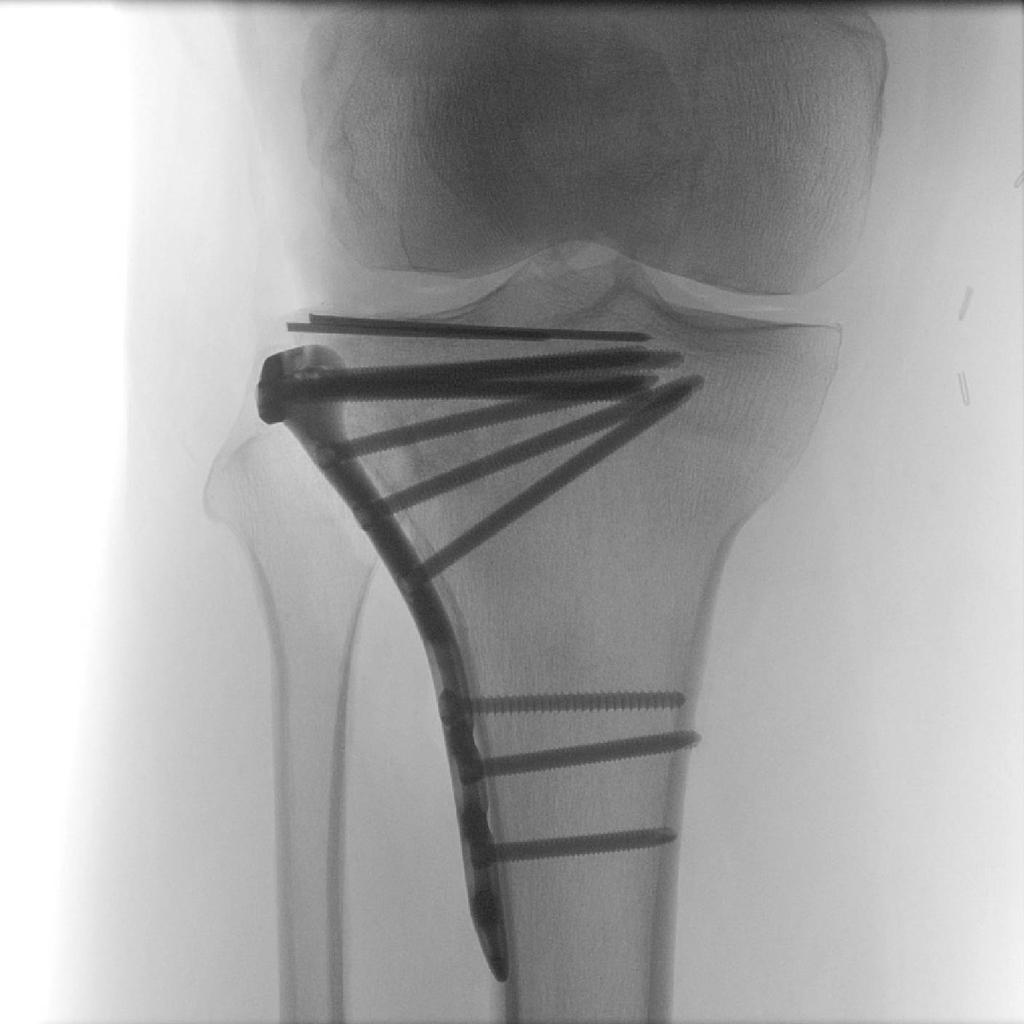 Tibia proximal - Siemens Healthineers Latinoamérica