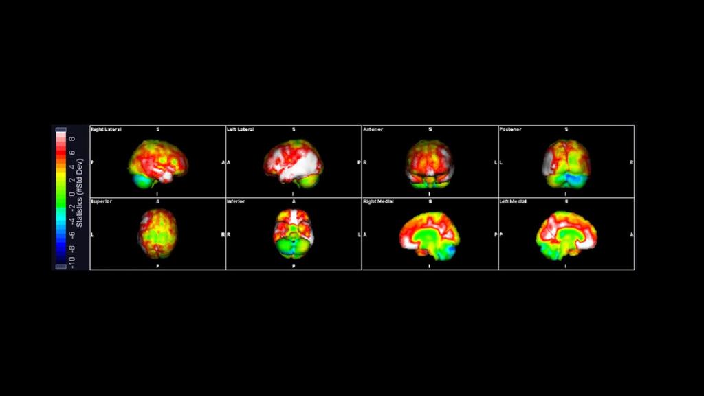Beta-amyloid PET/CT imaging in the assessment for anti-amyloid ...