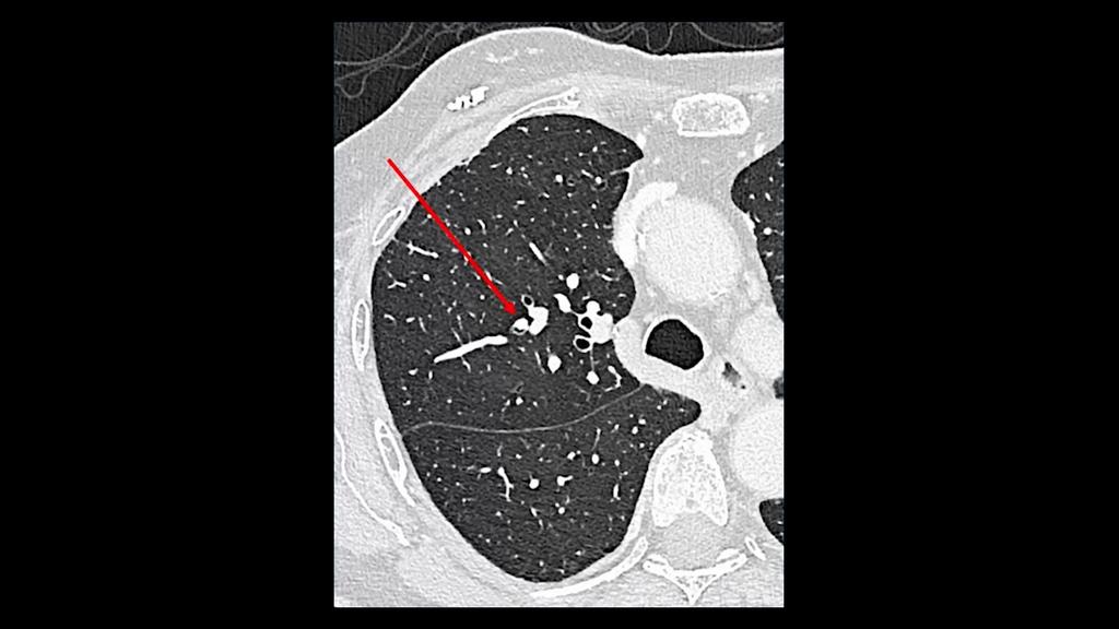 PCCT scientific evidence - Siemens Healthineers