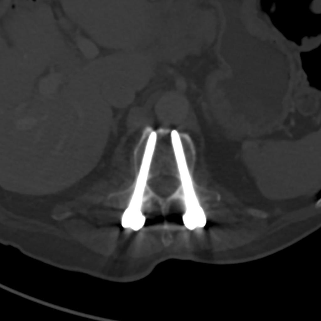 Imar Iterative Metal Artifact Reduction Siemens Healthineers
