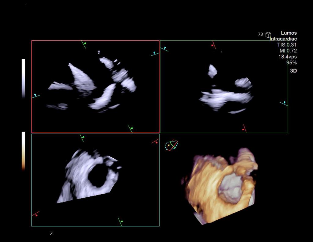 AcuNav Lumos 4D ICE Catheter - Siemens Healthineers