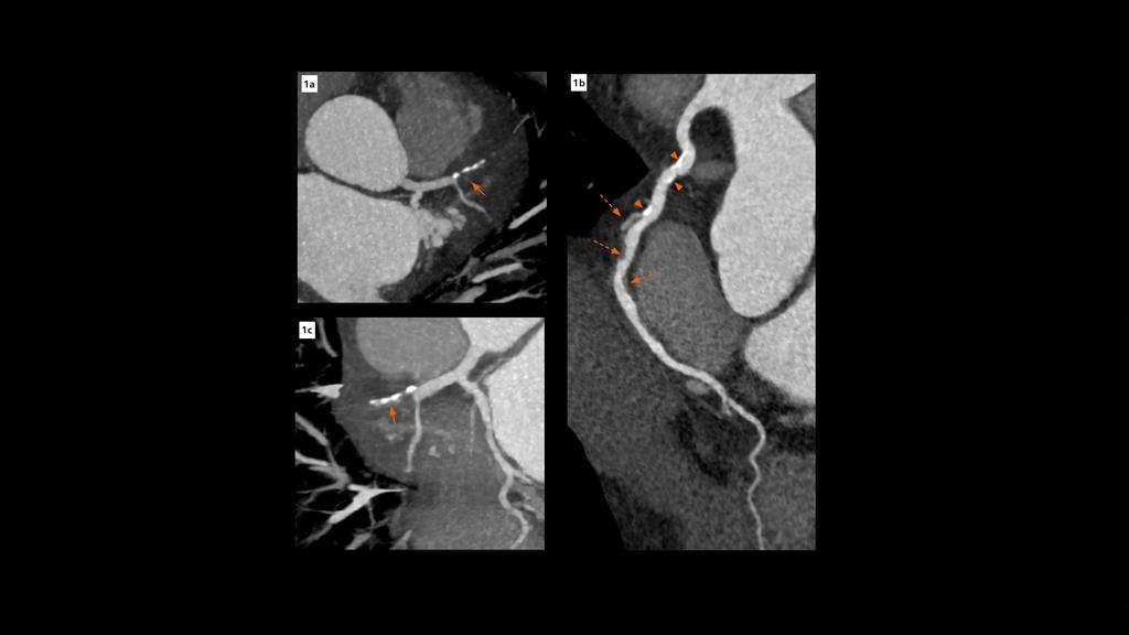 LAD occlusion – acute or chronic?