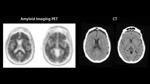 Beta-amyloid PET/CT imaging for Alzheimer's disease - Siemens Healthineers