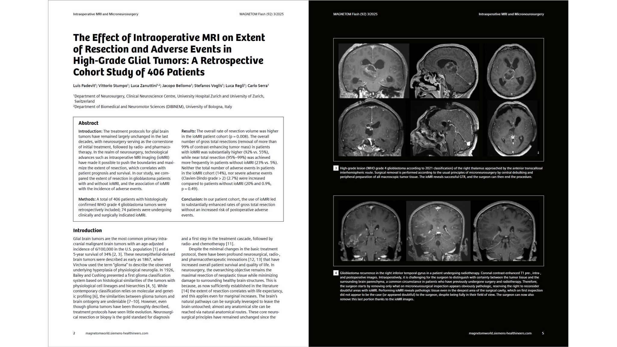 Intraoperative MRI-Guided Neurosurgery