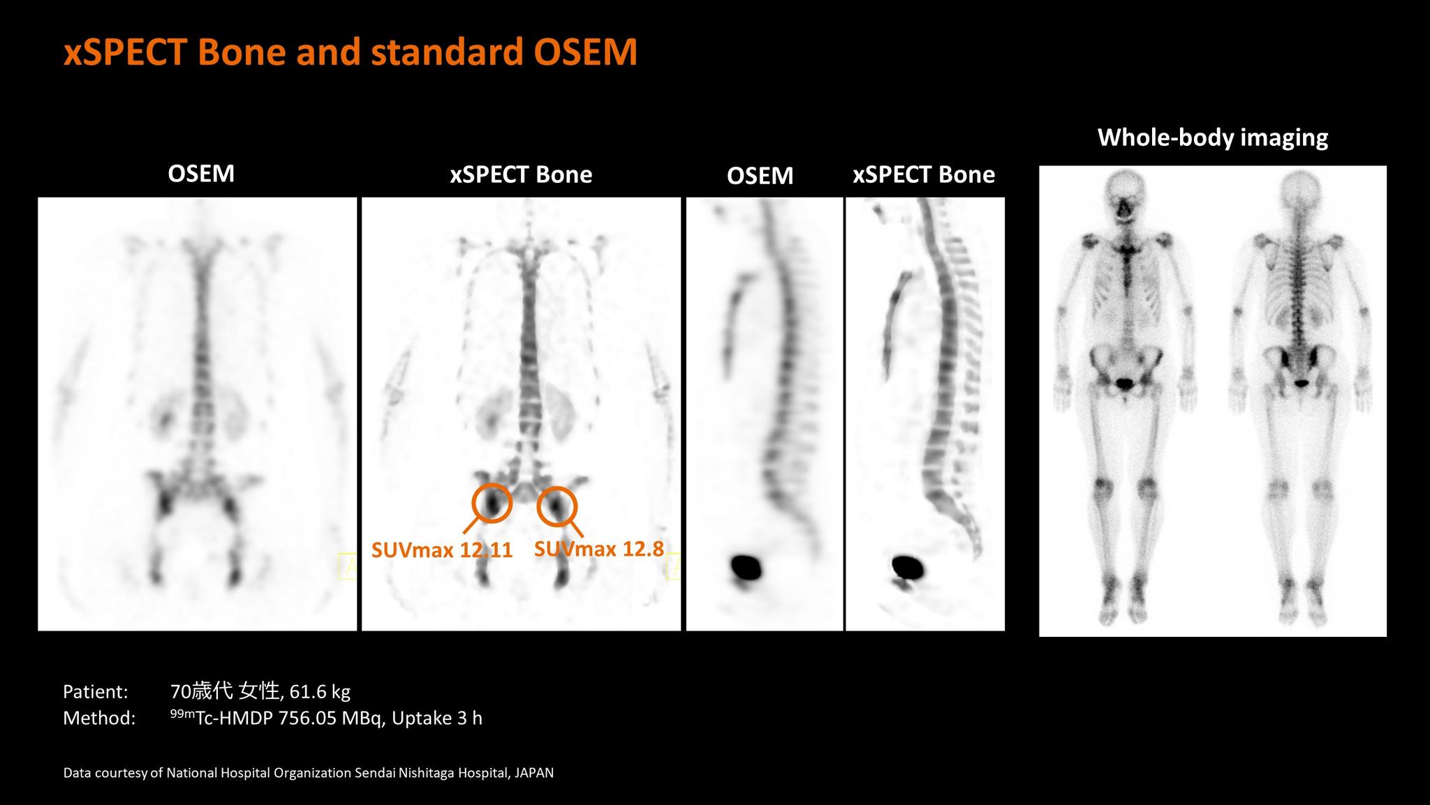 xSPECT Bone - Siemens Healthineers Japan