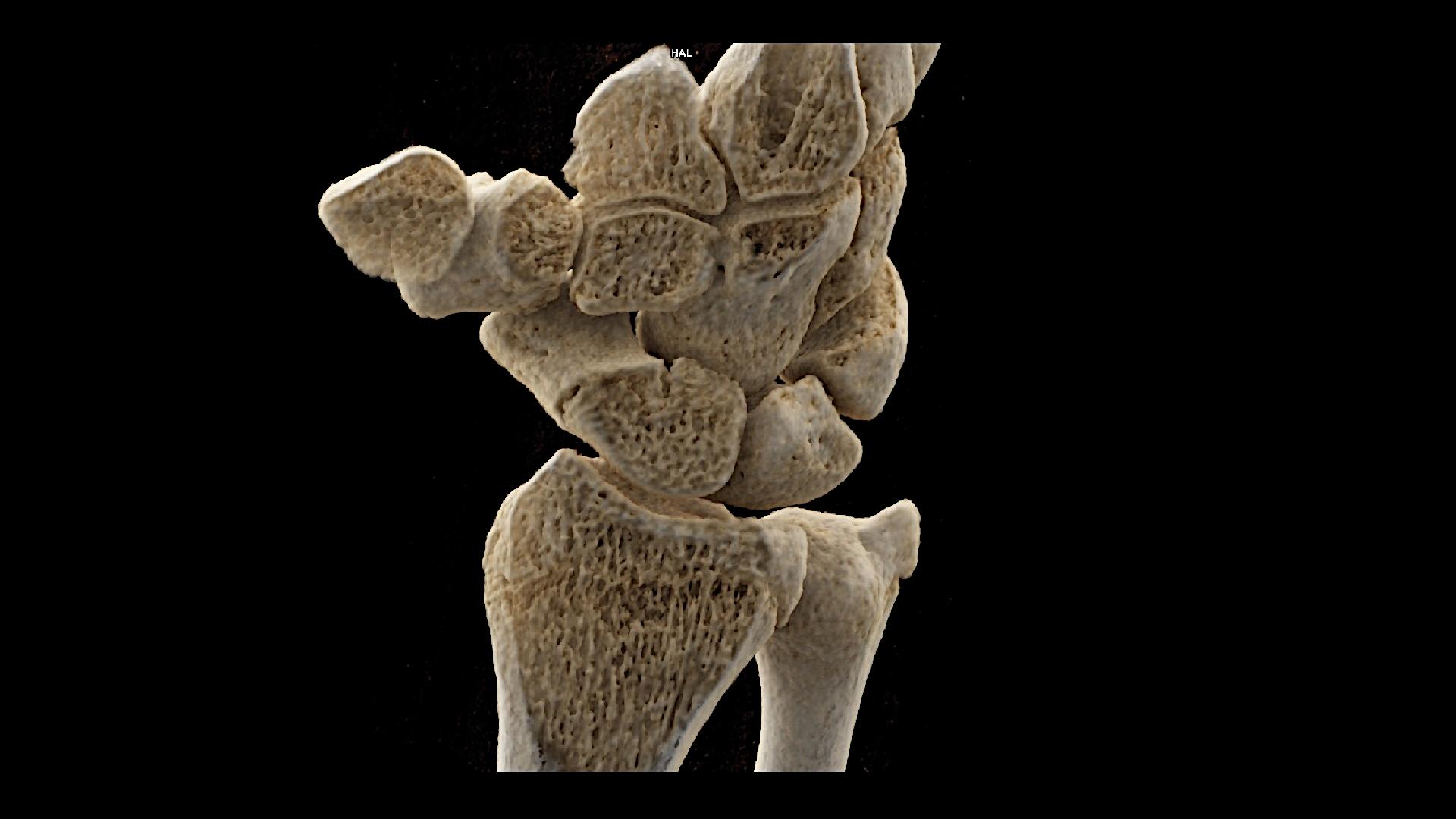 Scaphoid fracture only seen in CT - Siemens Healthineers