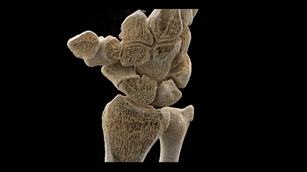 Scaphoid fracture only seen in CT - Siemens Healthineers