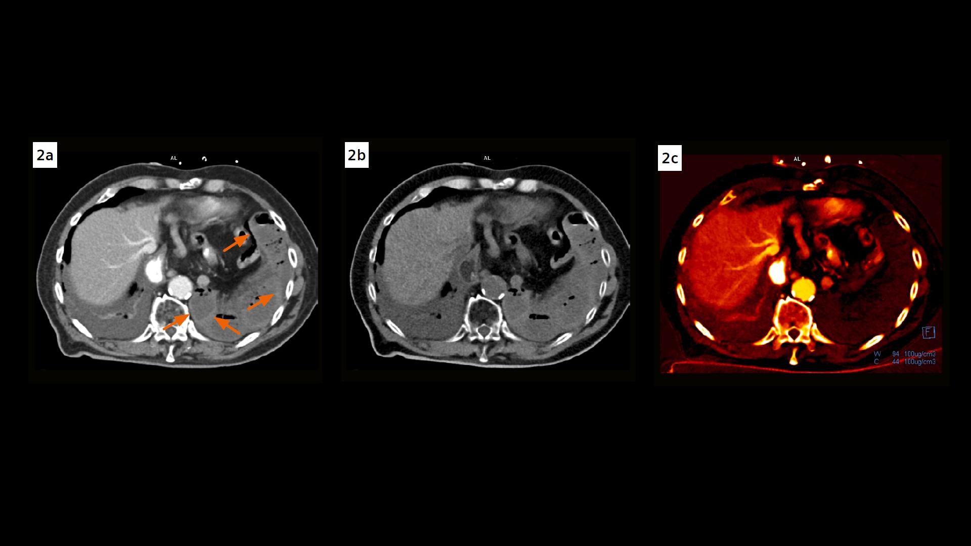 Small bowel infarction secondary to an acquired diaphragmatic hernia ...