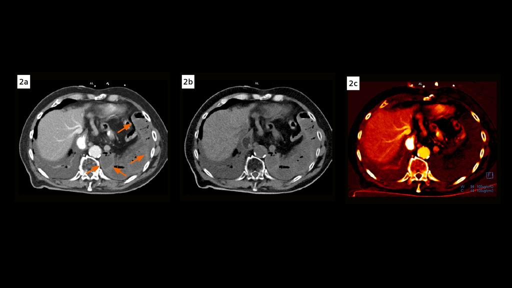 Small bowel infarction secondary to an acquired diaphragmatic hernia ...