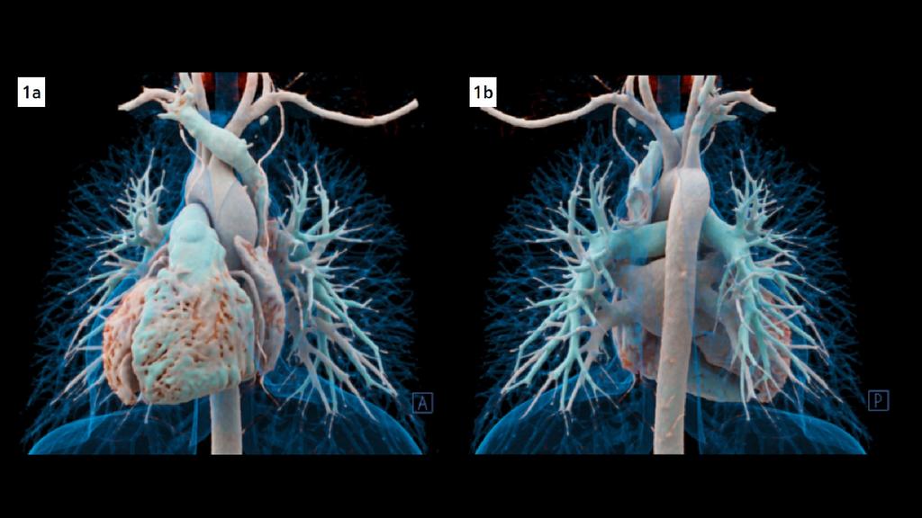 Situs inversus totalis discovered incidentally in an adult - Siemens ...