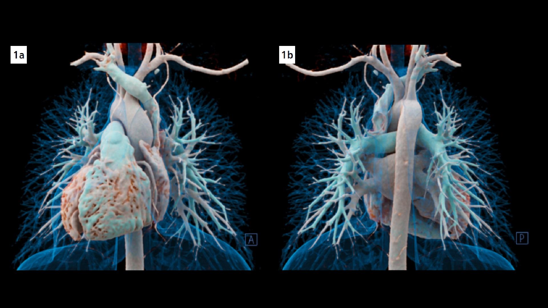 Situs inversus totalis discovered incidentally in an adult - Siemens ...
