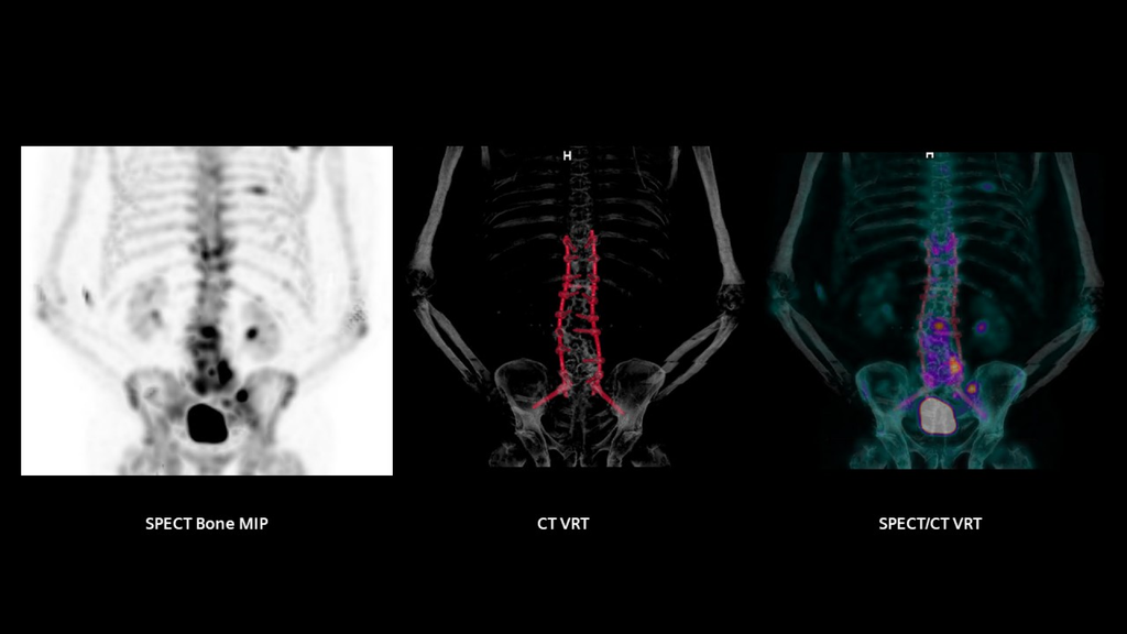 SPECT/CT in musculoskeletal medicine - Siemens Healthineers