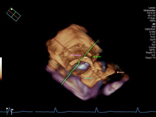 AcuNav Lumos 4D ICE Catheter - Siemens Healthineers