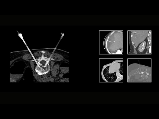 Simplify CT-guided interventions with myNeedle Companion - Siemens ...