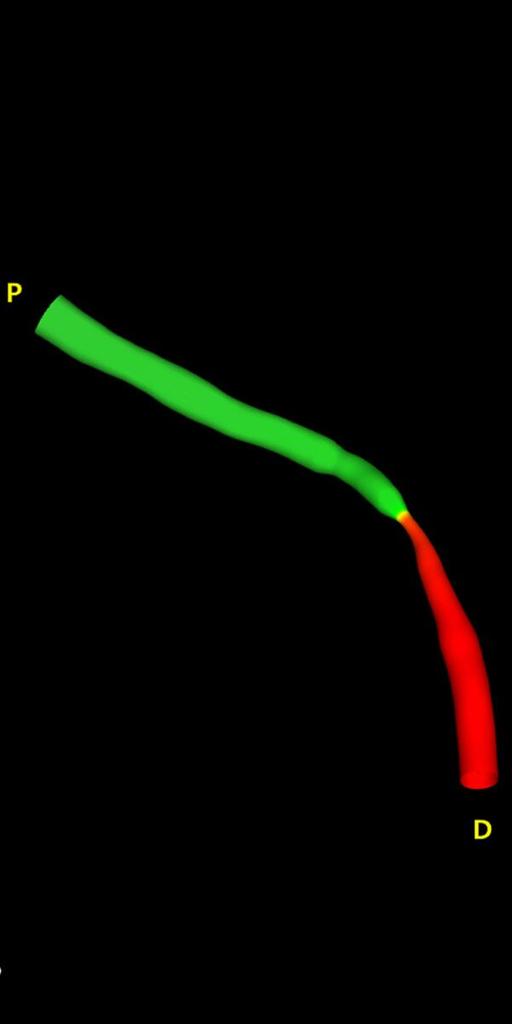 Rethink FFR assessment for every patient - Siemens Healthineers