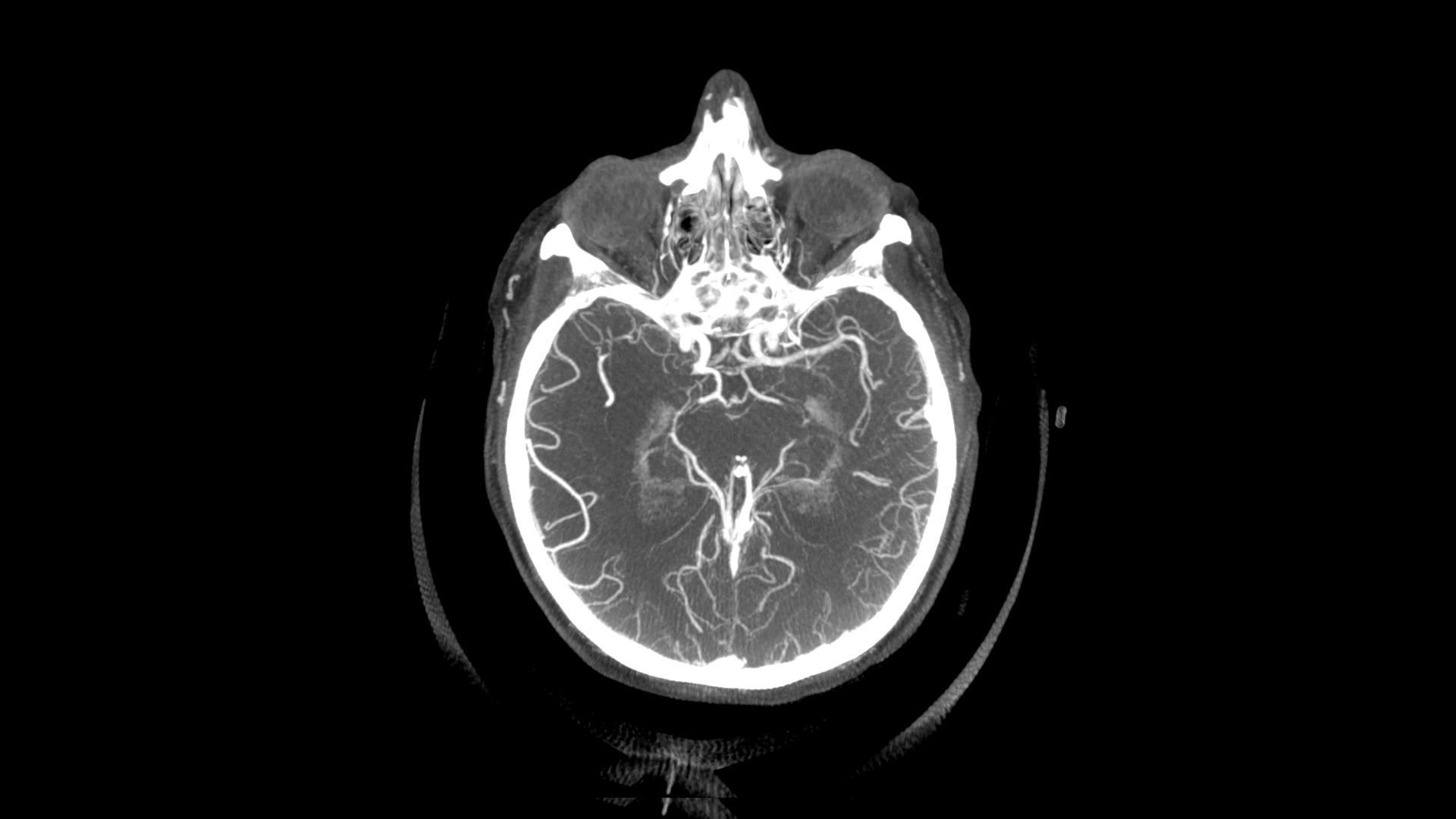 syngo DynaCT - Siemens Healthineers USA