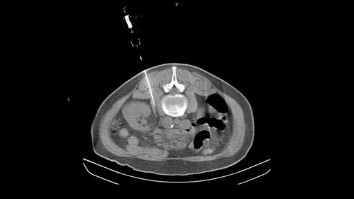 CT-guided interventions - Siemens Healthineers