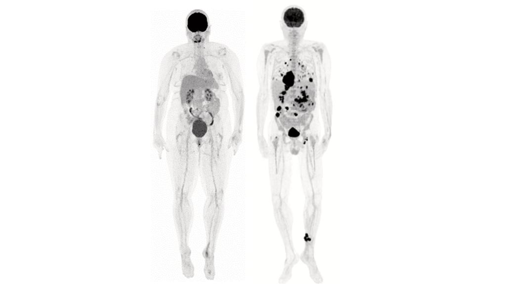 PETNET On Oncology - Siemens Healthineers USA