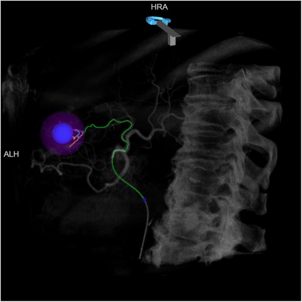 Interventional Oncology Procedures - Siemens Healthineers