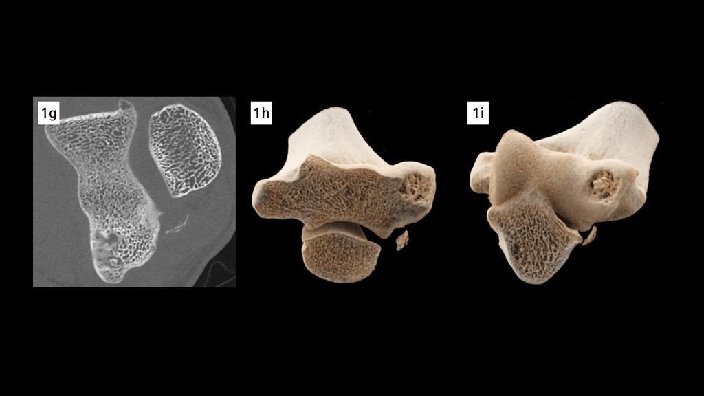 Osteochondritis dissecans of the capitellum - Siemens Healthineers