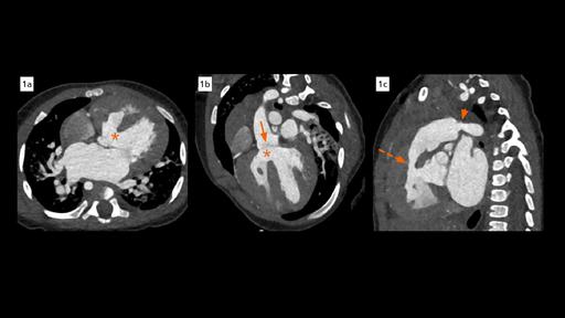 Preoperative evaluation in a case of Tetralogy of Fallot - Siemens ...