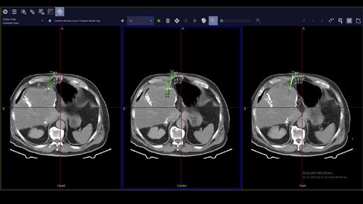 CT-guided interventional procedures on SOMATOM go.platform - Siemens ...