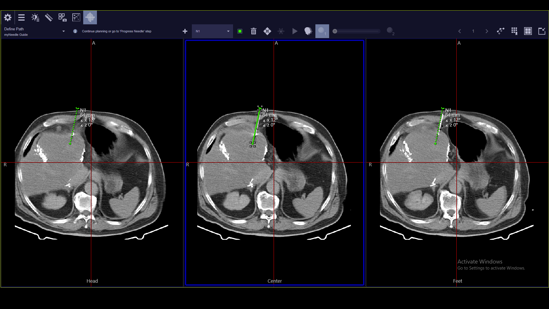 CT-guided interventional procedures on SOMATOM go.platform - Siemens Healthineers USA