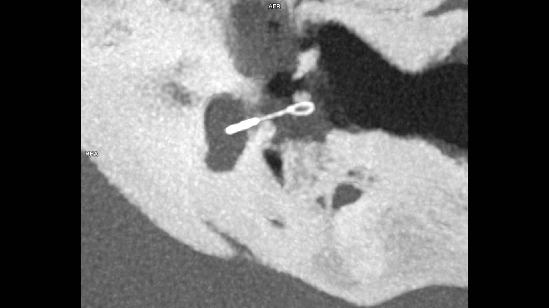 NAEOTOM Alpha photon-counting CT scanner - Siemens Healthineers Canada