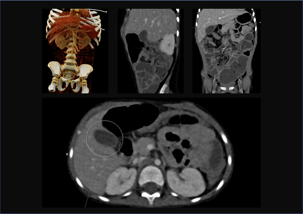 Ultra-Low Dose Free Breathing Pediatric CT Imaging
