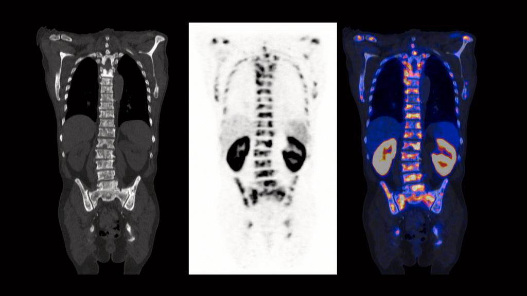 Fast, quantitative SPECT/CT acquisition following multiple therapy ...