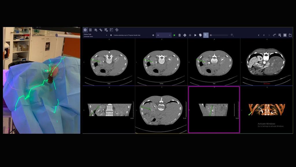Liver Cancer Management - Siemens Healthineers