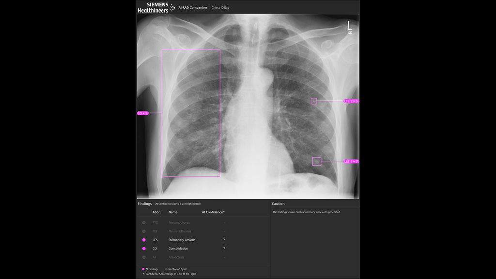 AI-Rad Companion - Siemens Healthineers