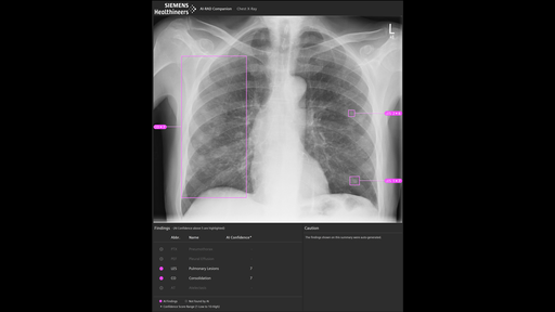 AI-Rad Companion - Siemens Healthineers