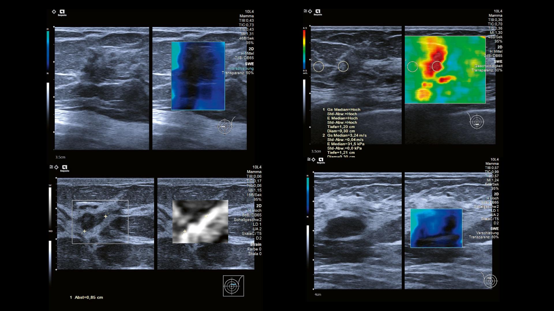 Casos prácticos de ultrasonido de mama - Siemens Healthineers Latinoamérica