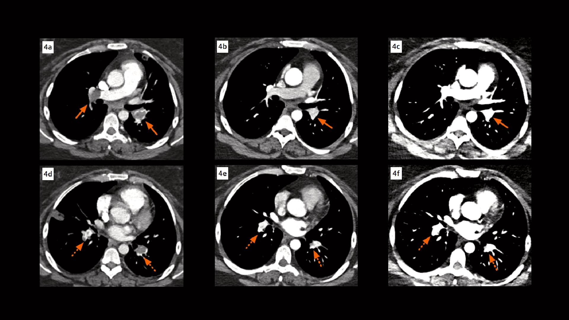 Follow-up of an acute pulmonary embolism in an obese patient with an ...