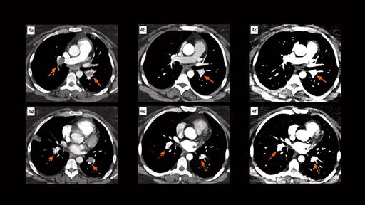 Follow-up of an acute pulmonary embolism in an obese patient with an ...