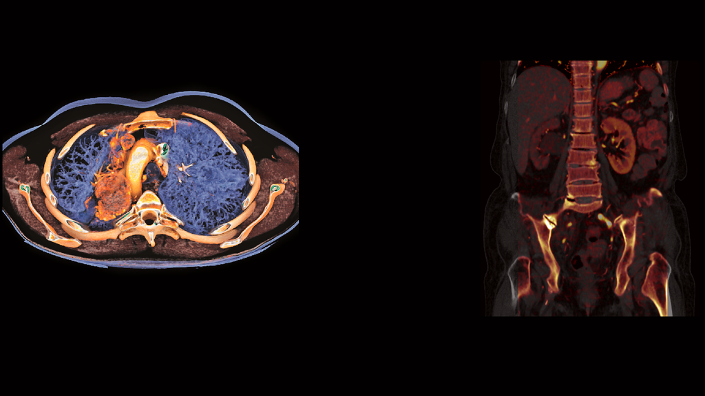 Computed Tomography for Oncology - Siemens Healthineers