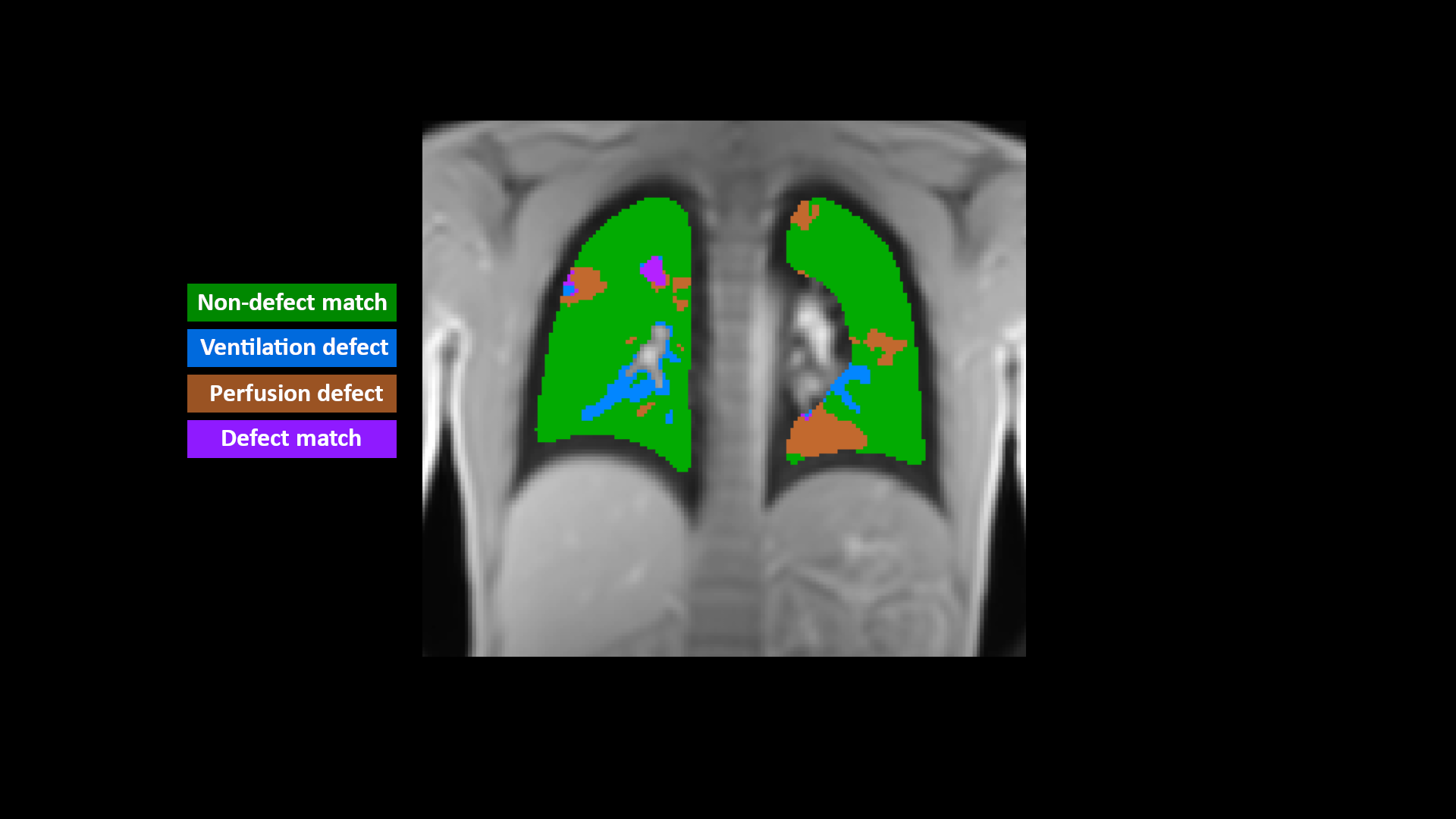 LungMaps - Siemens Healthineers India