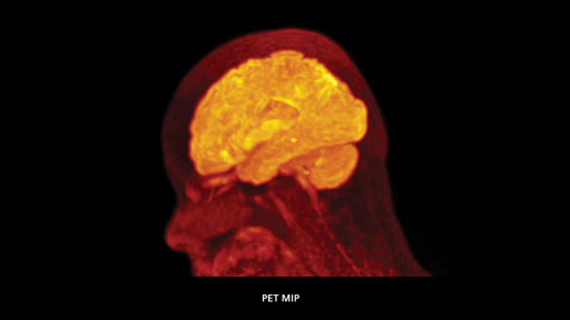 Biograph Vision PET/CT Clinical Image Gallery - Siemens Healthineers