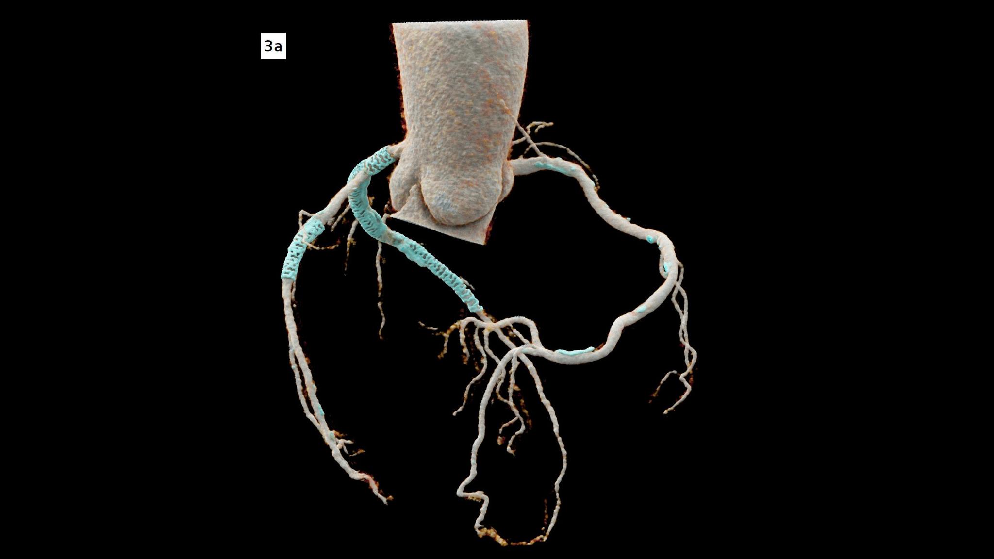 Multiple coronary stents – in-stent restenosis - Siemens Healthineers USA