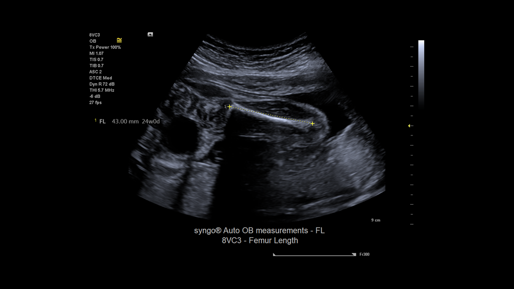 ACUSON Juniper Ultrasound System - Siemens Healthineers Malaysia