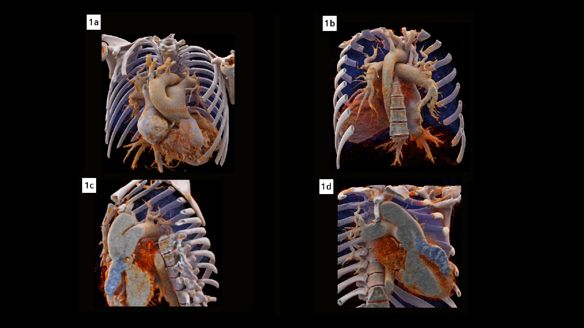 Unrepaired persistent truncus arteriosus in an adult - Siemens Healthineers
