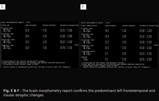 Clinical Advantage of MRI morphometry in brain atrophy; a case of Aphasia