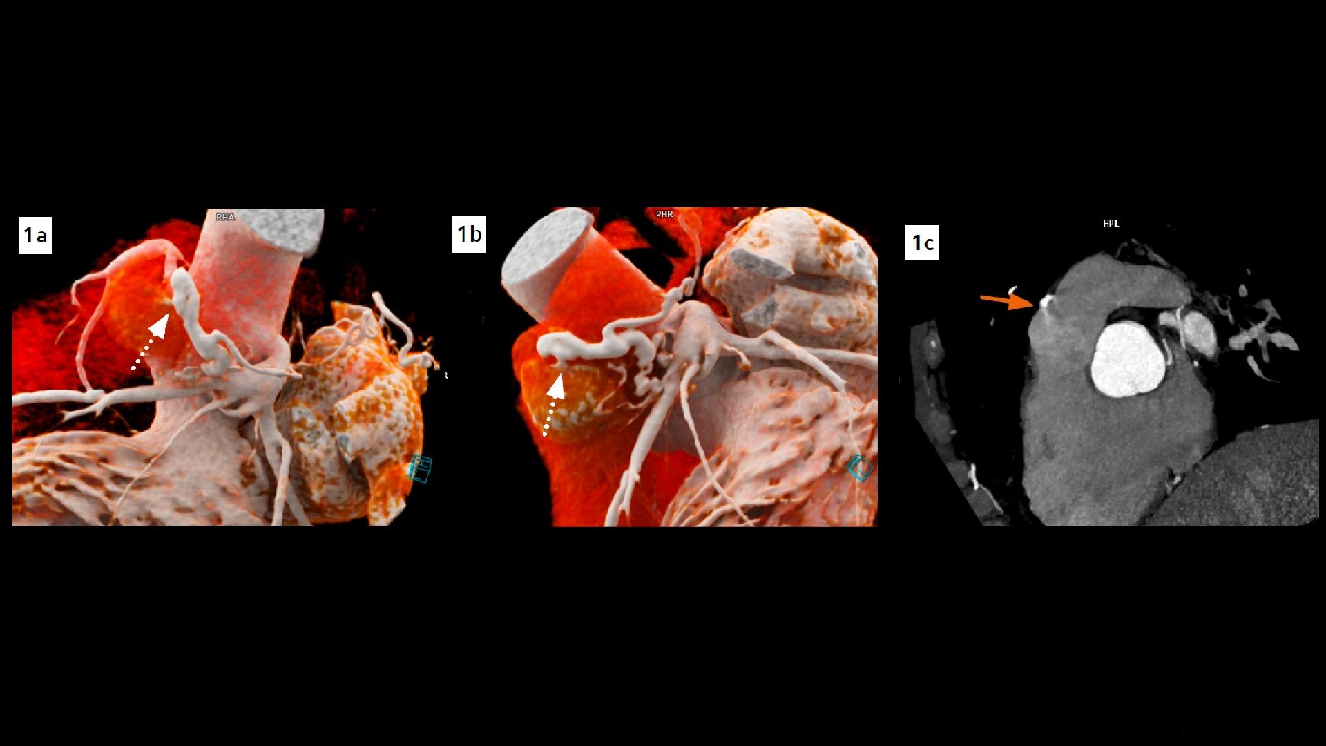 Complex Coronary Artery Fistulas & Aneurysm in an Asymptomatic Patient ...